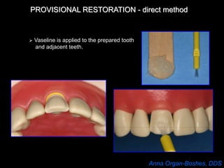 Veneer Preparation and Provisional | PPT