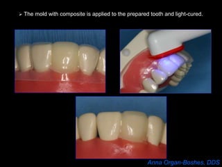 Veneer Preparation and Provisional | PPT