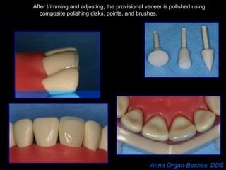 Veneer Preparation and Provisional | PPT