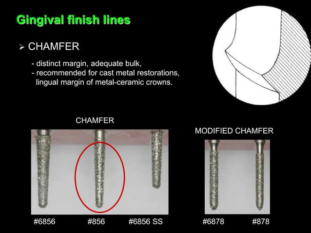 Veneer Preparation and Provisional | PPT