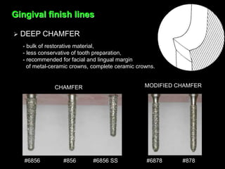 Veneer Preparation and Provisional | PPT