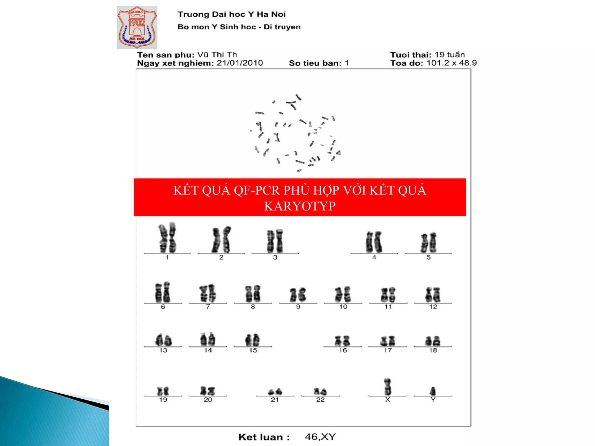 Nghiên cứu ứng dụng kỹ thuật QF-PCR Trong Chẩn Đoán Trước Sinh Các Hội Chứng Lệch Bội NST | PPS