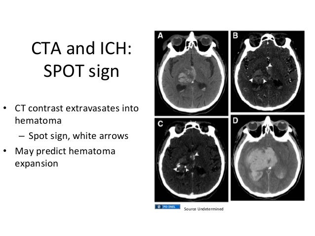 GEMC: Intracerebral Hemorrhage (ICH): Resident Training