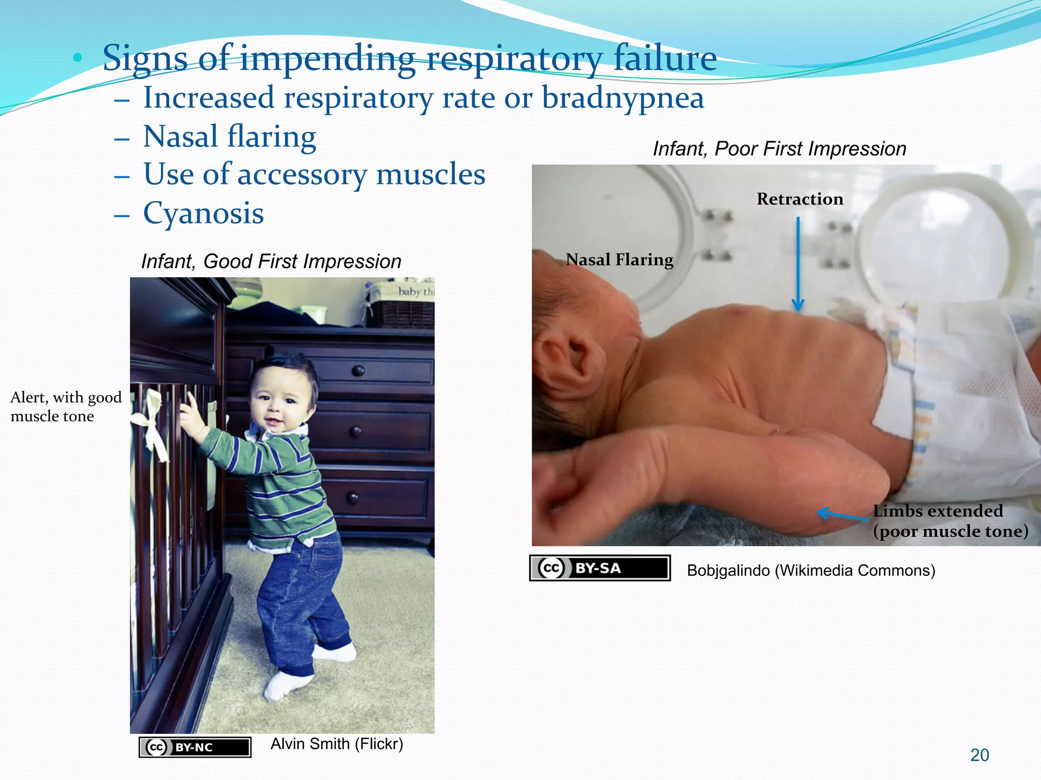 GEMC: Pediatric Respiratory Distress: Resident Training | PDF
