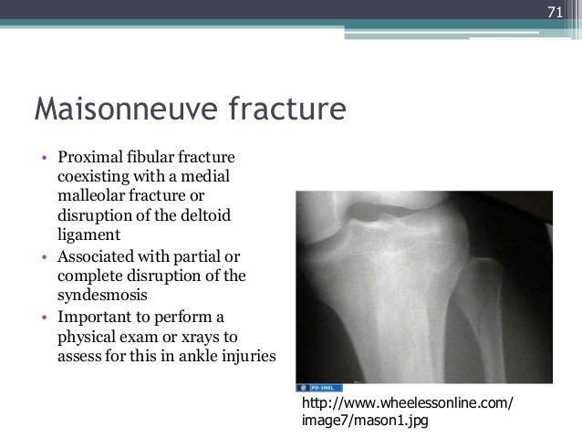 Maisonneuve Type Fracture ~ Maison Maison Design