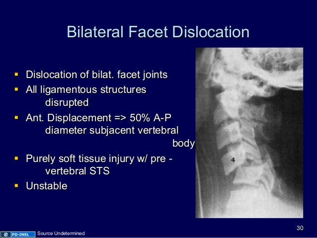 Unilateral Facet Dislocation Cervical Spine Injuries: Part II | 2012-07 ...