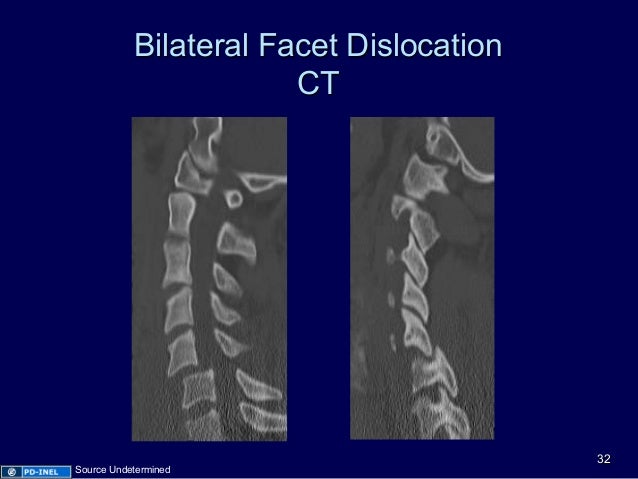 Bilateral Facet Dislocation