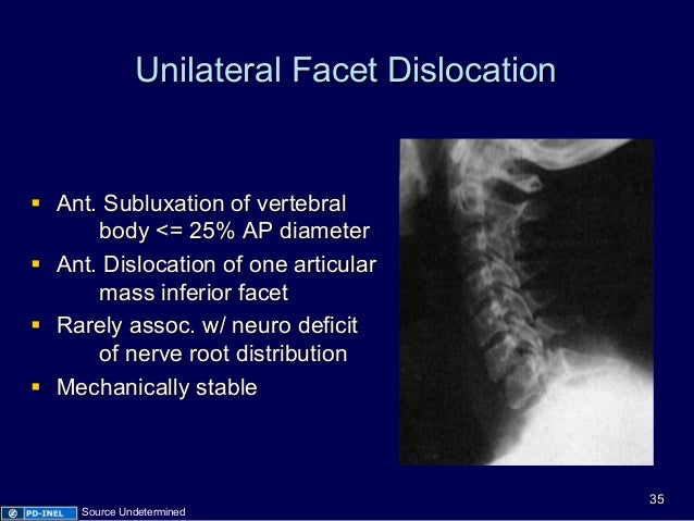Unilateral Facet Dislocation Cervical Spine Injuries: Part II | 2012-07 ...
