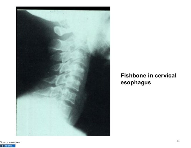 GEMC: Aspirated and Ingested Foreign Bodies: Resident Training