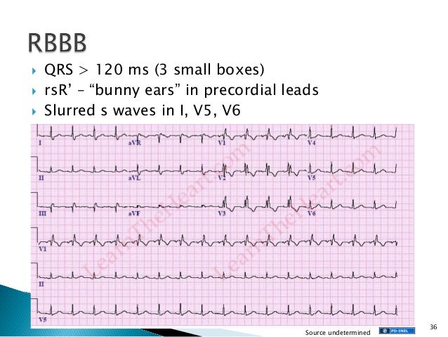 GEMC- EKG and Rhythm Interpretation 101-for Residents