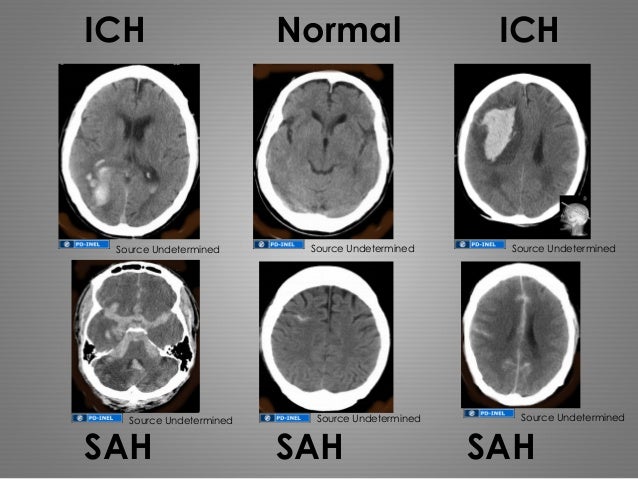GEMC: Systematic Evaluation to Non-Traumatic Head CTs: Resident Train…