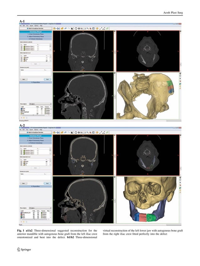 2012 modabber-unterkieferrekonstruktion-becken | PDF
