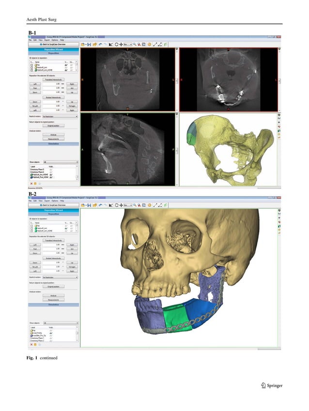 2012 modabber-unterkieferrekonstruktion-becken | PDF