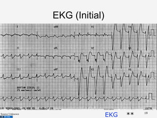 Pulseless Electrical Activity Ekg