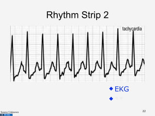 Pulseless Electrical Activity Ecg Strip