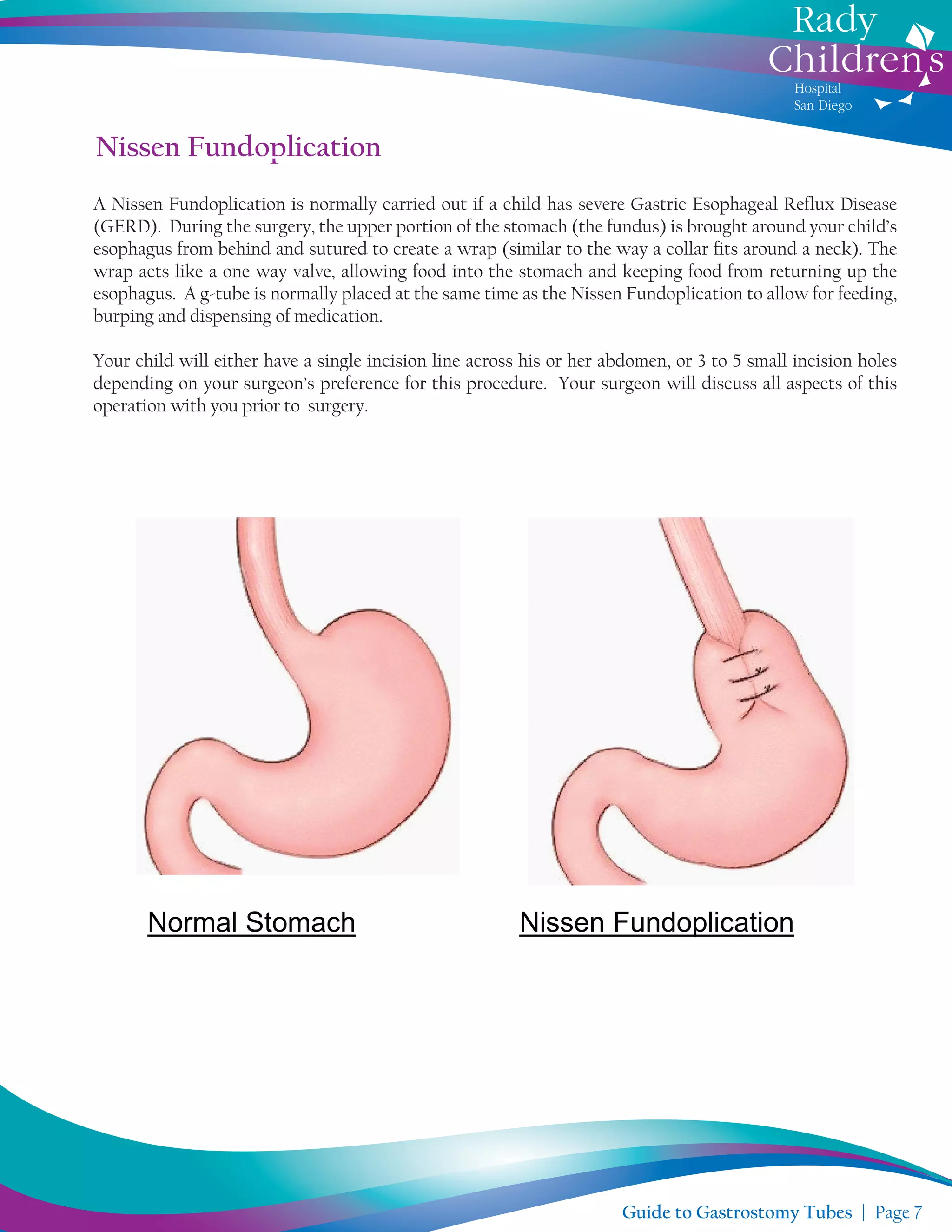 Guide to Gastrostomy Tubes | PDF