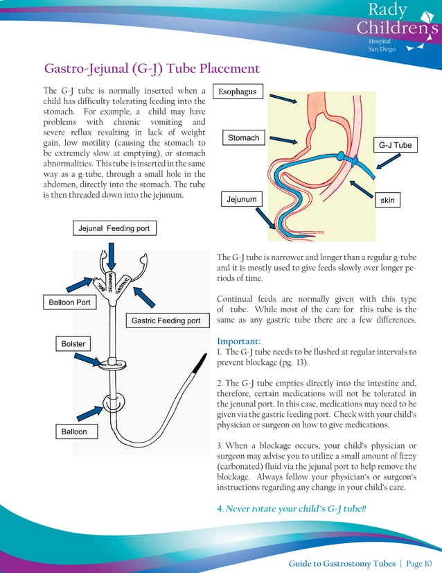 Guide to Gastrostomy Tubes