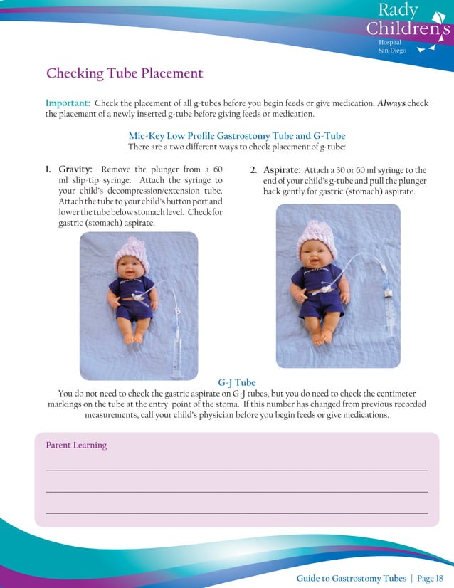 Gastrostomy Tube Care Handout: Gastrostomy Tube Removal Guidelines – KQJJX