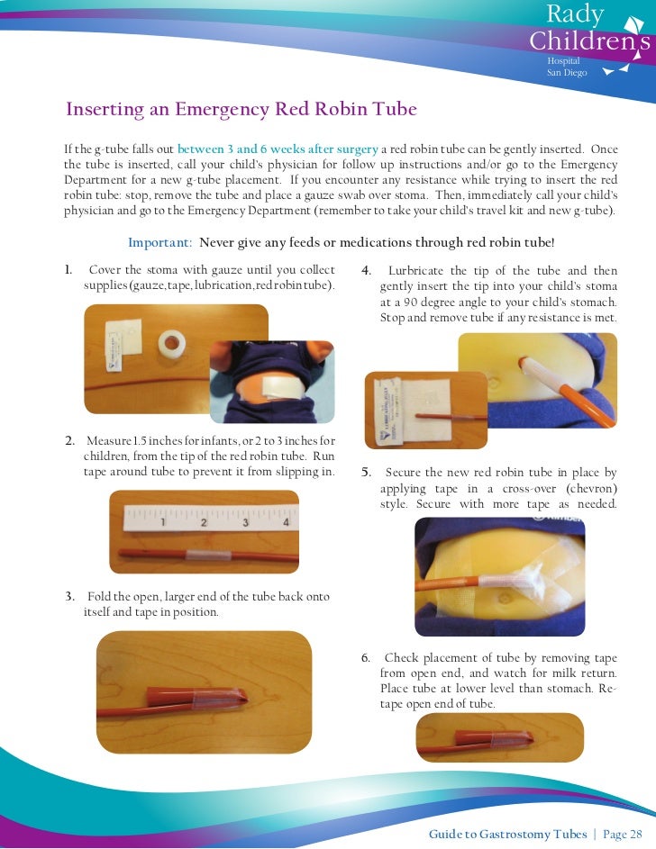 Guide to Gastrostomy Tubes