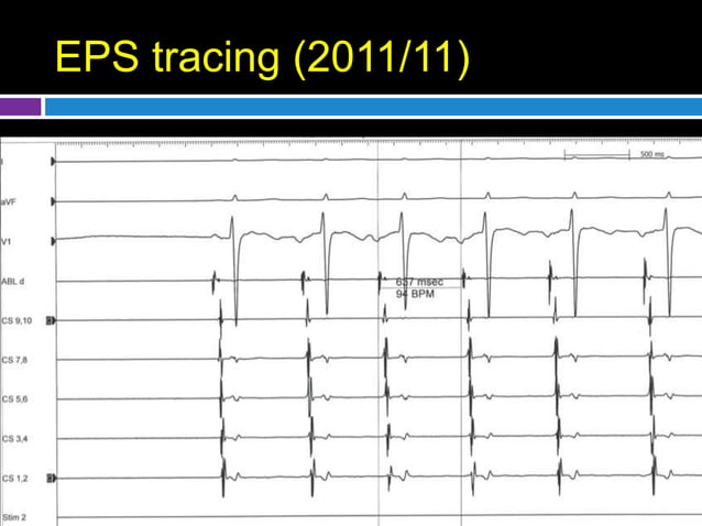 Ectopic Paroxysmal Atrial Tachycardia | PPTX | Heart and Cardiovascular ...