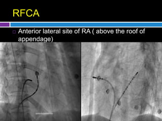 Ectopic Paroxysmal Atrial Tachycardia | PPTX | Heart and Cardiovascular ...