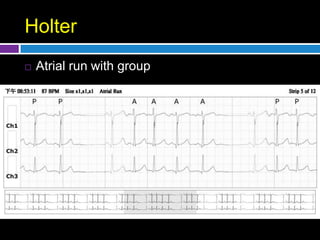 Ectopic Paroxysmal Atrial Tachycardia | PPTX