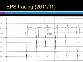 Paroxysmal Atrial Tachycardia Ecg