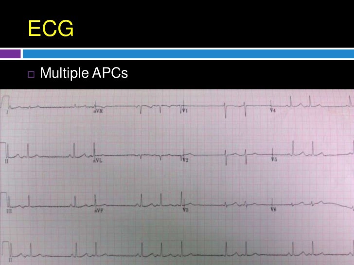 Icd 10 for paroxysmal atrial fibrillation - stupidhisa