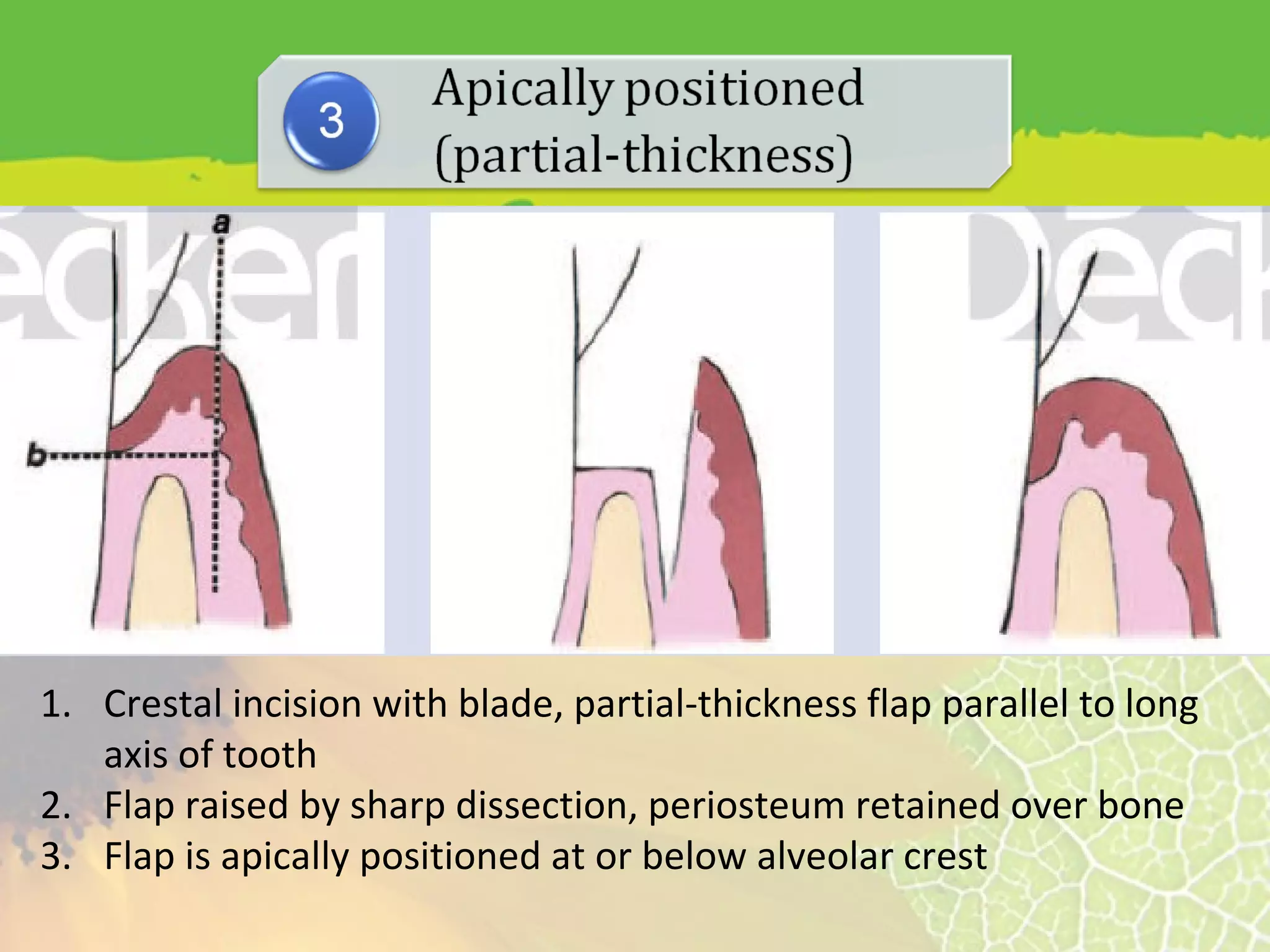 Periodontal Flap Surgery | PPT