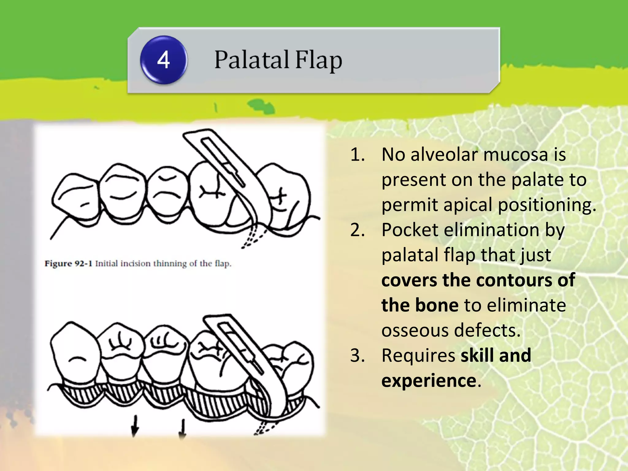 Periodontal Flap Surgery | PPT