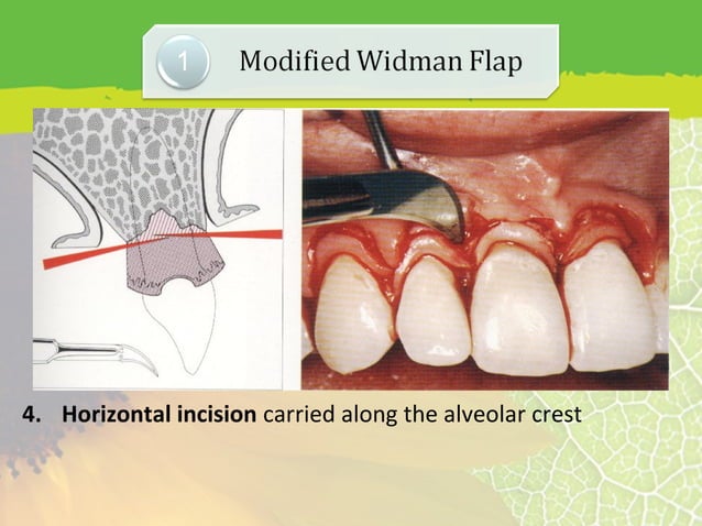 Periodontal Flap Surgery | PPT