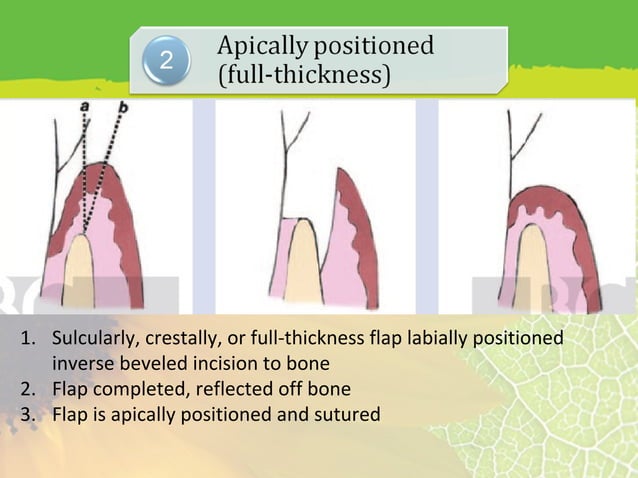 Periodontal Flap Surgery | PPT