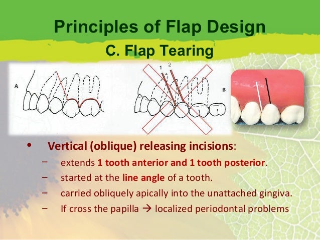 Periodontal Flap Surgery