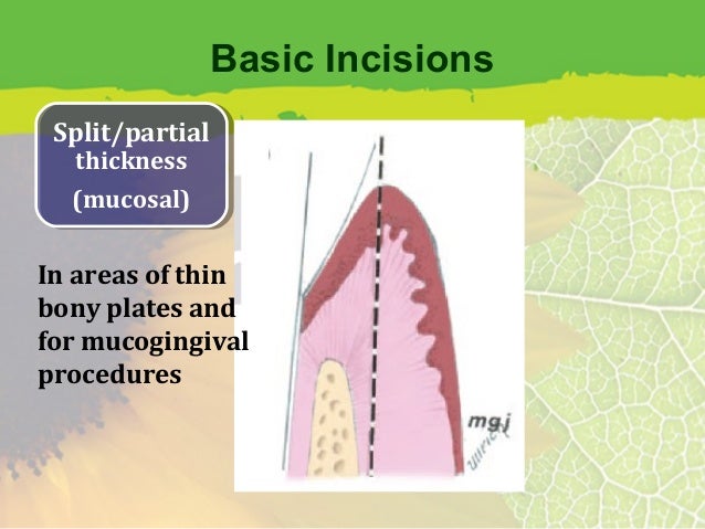 Periodontal Flap Surgery
