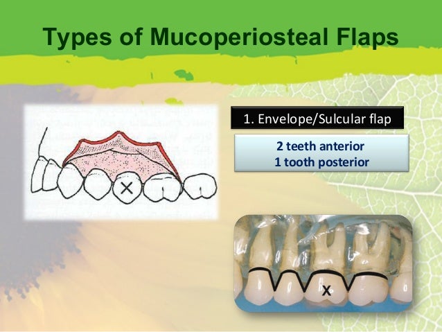 Periodontal Flap Surgery