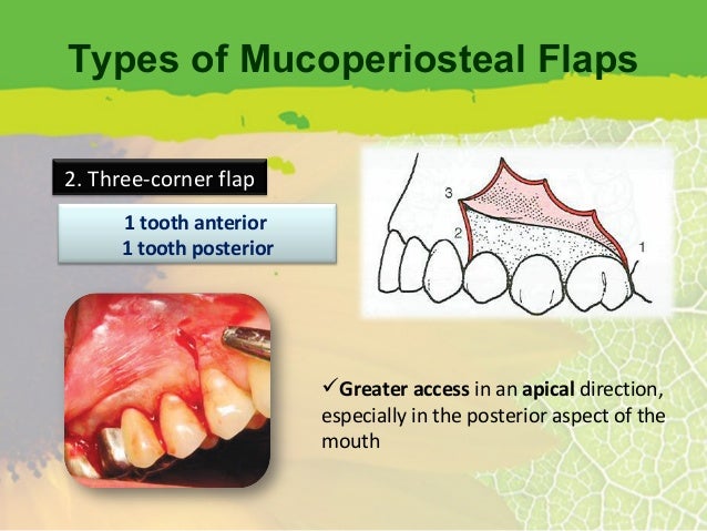 Periodontal Flap Surgery
