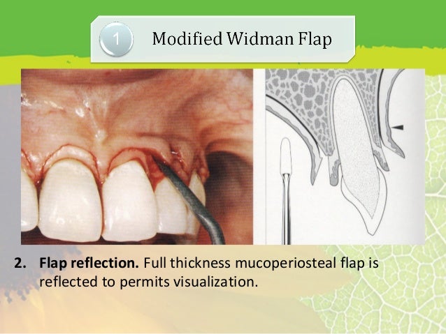 Periodontal Flap Surgery