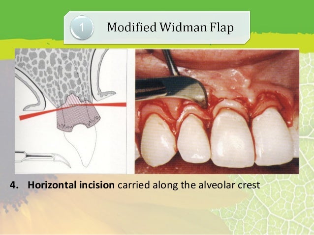 Periodontal Flap Surgery