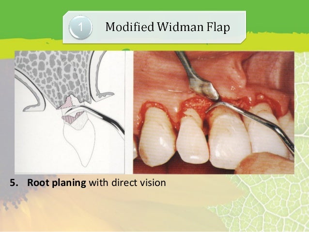 Periodontal Flap Surgery