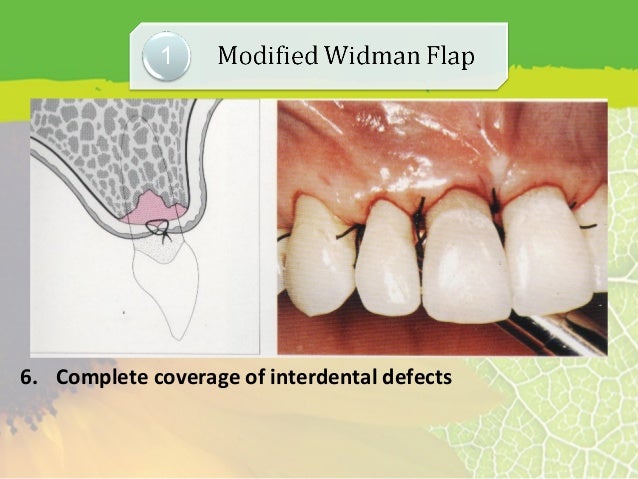 Periodontal Flap Surgery