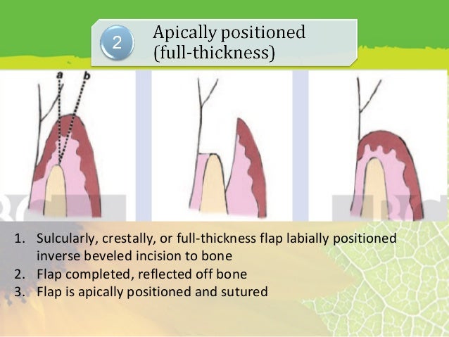 Periodontal Flap Surgery