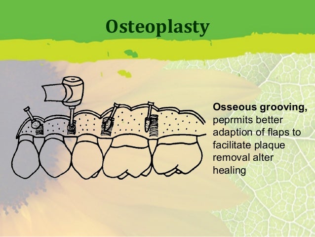 Periodontal Flap Surgery