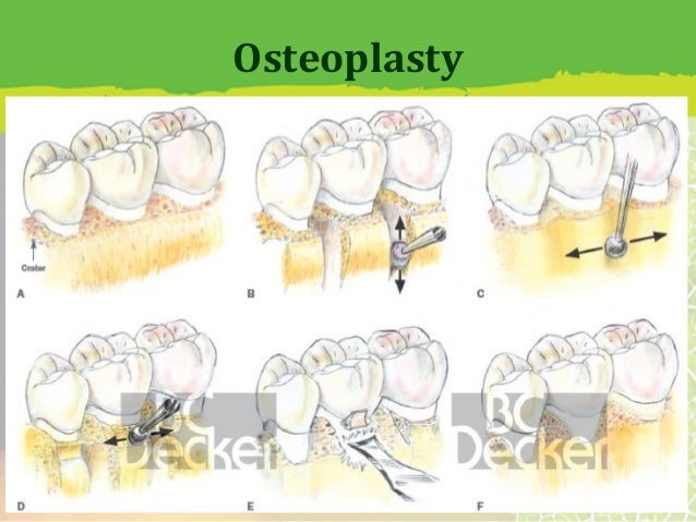 Periodontal Flap Surgery