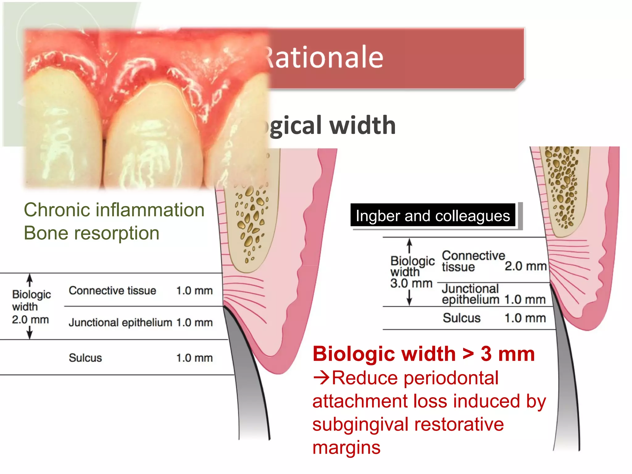 Contemporary Crown-lengthening Therapy | PPT