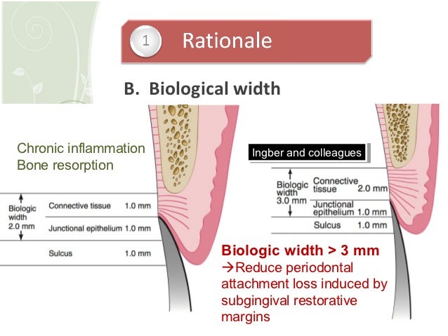 Contemporary Crown-lengthening Therapy