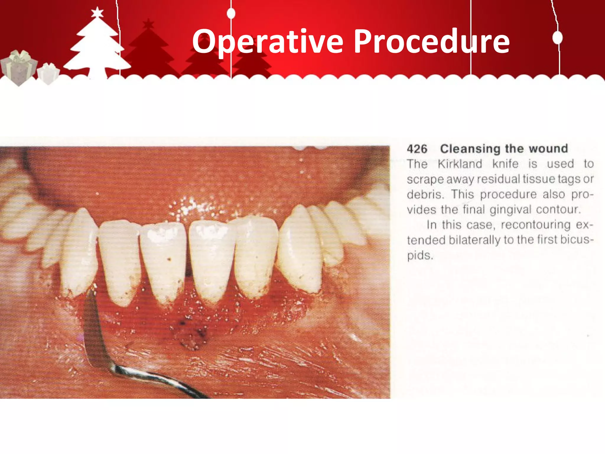 Gingivectomy | PPT