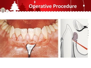 Gingivectomy | PPT