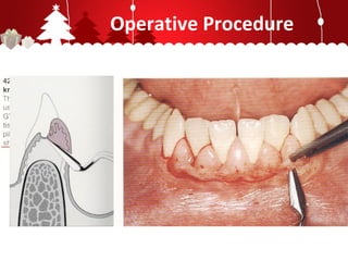 Gingivectomy | PPT