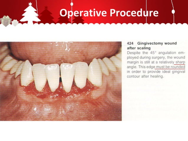 Gingivectomy | PPT | Oral care | Personal Care