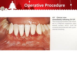Gingivectomy | PPT
